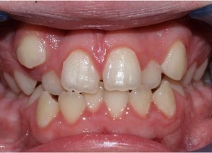 Ortodoncia para colmillos montados o caninos elevados