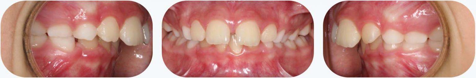 Protrusión dental. Qué es y cómo se trata | Ortodoncia Barcelona