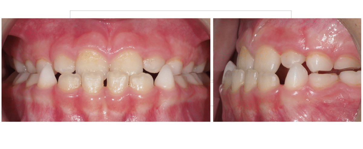 Prognatismo: causas, efectos y tratamiento