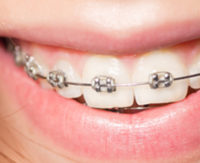 Brackets transparentes y estéticos Barcelona | Niños y jóvenes